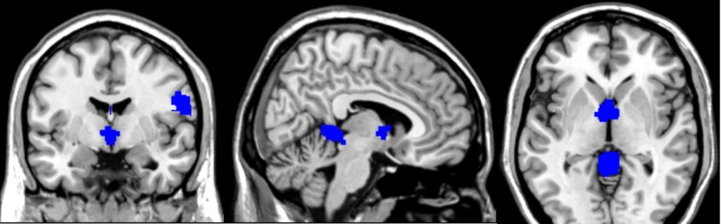 Unlocking the Brain in Functional Neurological Disorders: What Research ...